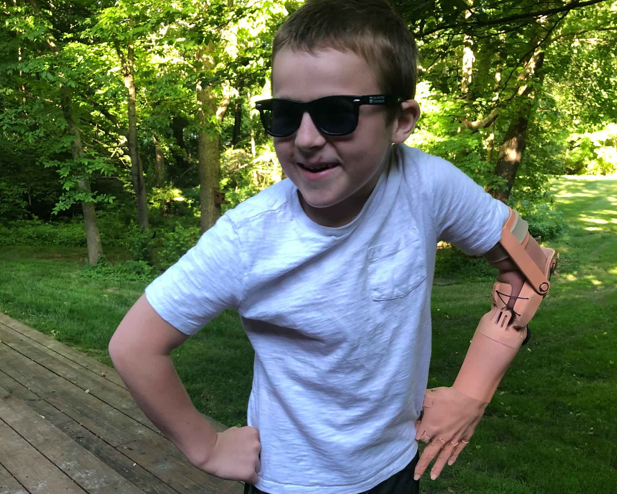 Why We're Passionate About Prosthetics for Children - Unlimited Tomorrow